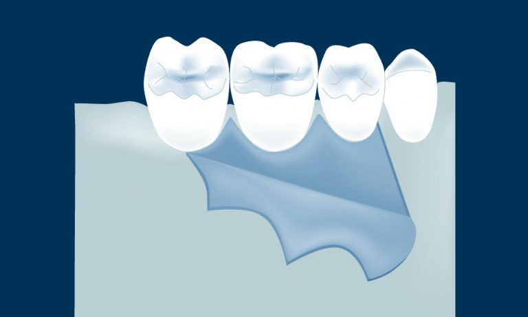 Principles of flap design in dental implantology - ITI Blog