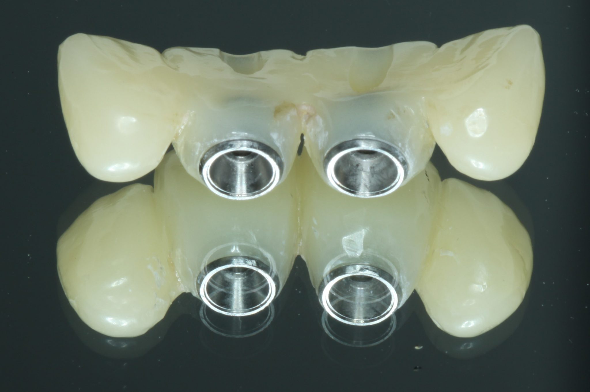 Implant abutment selection in fixed prosthodontics - ITI Blog