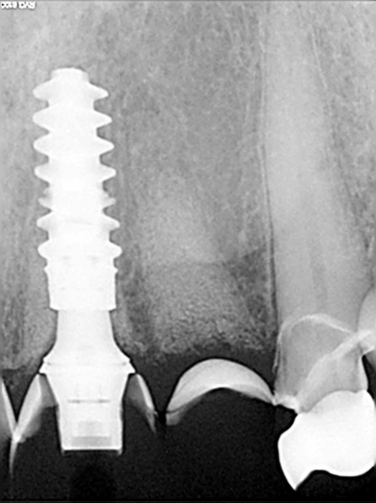 Implant abutment selection in fixed prosthodontics - ITI Blog