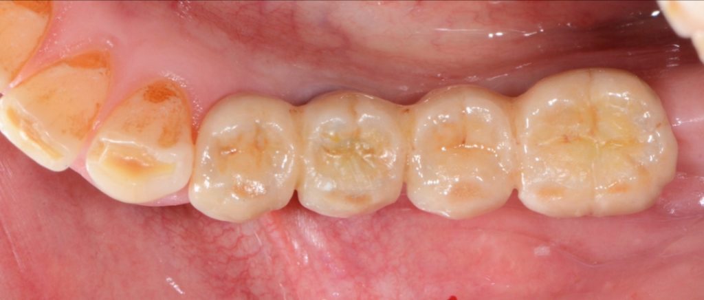 Ceramic materials in implant dentistry: Overview - ITI Blog