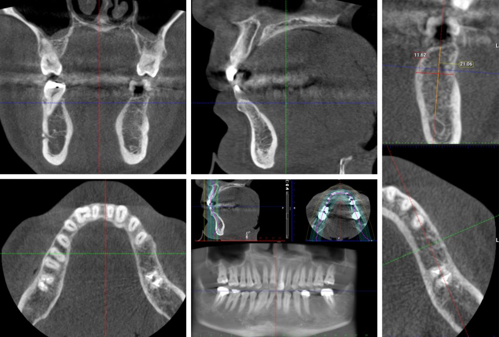 Dental CT scan vs. Cone Beam CT: an overview - ITI Blog