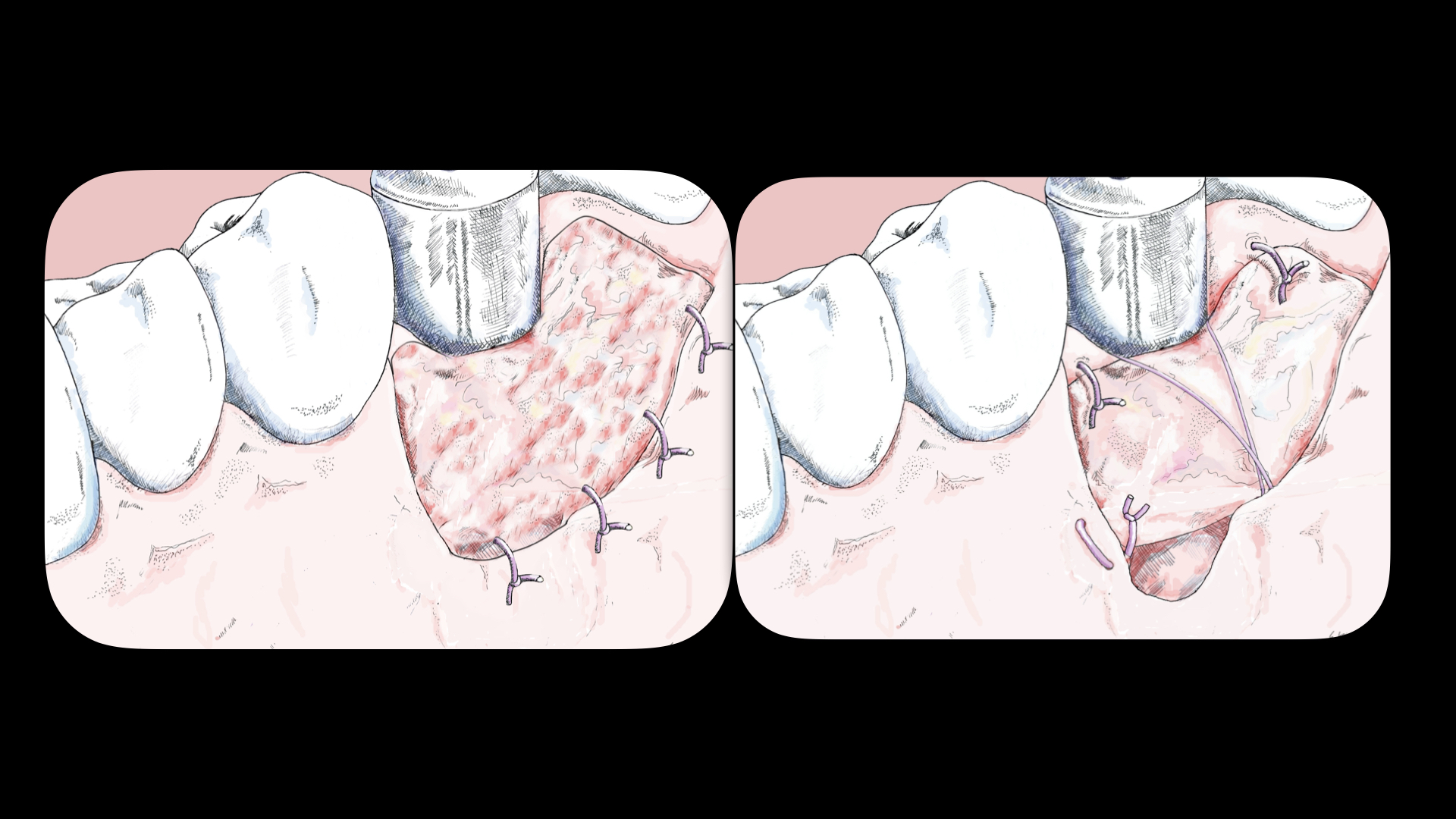 Soft tissue management around dental implants - ITI Blog