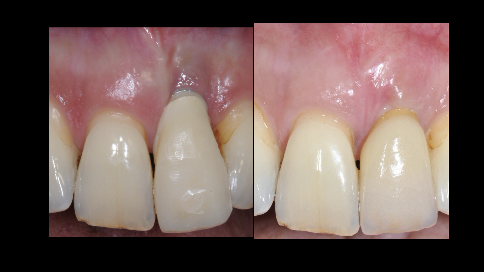Soft tissue management around dental implants - ITI Blog