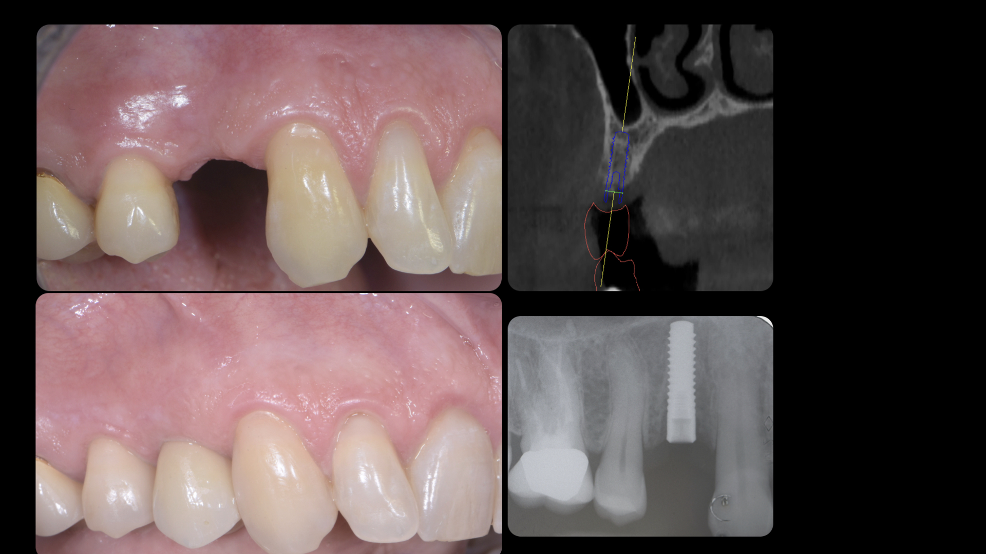 Soft tissue management around dental implants - ITI Blog
