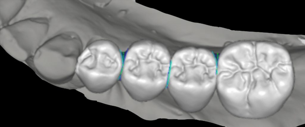 Ceramic materials in implant dentistry: Overview - ITI Blog