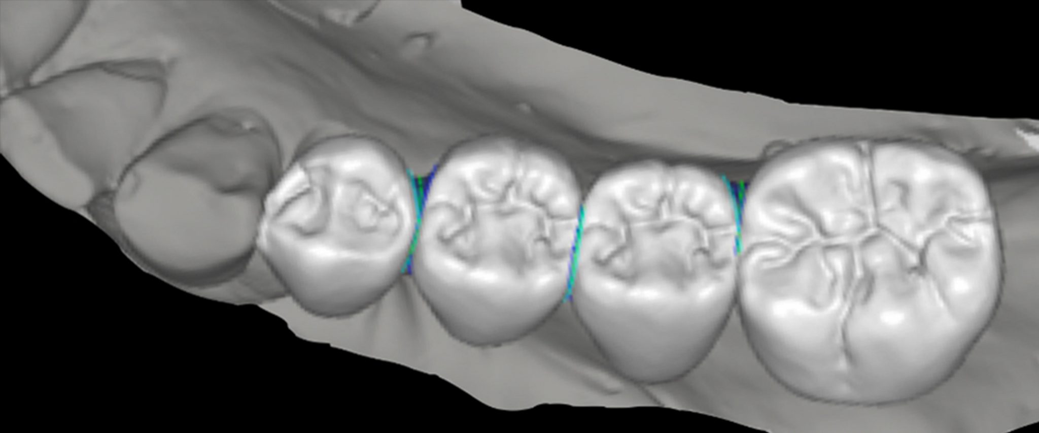 Ceramic materials in implant dentistry: Overview - ITI Blog