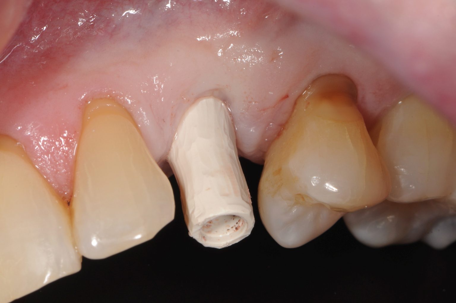 Dental implant-supported transitional prostheses - ITI Blog