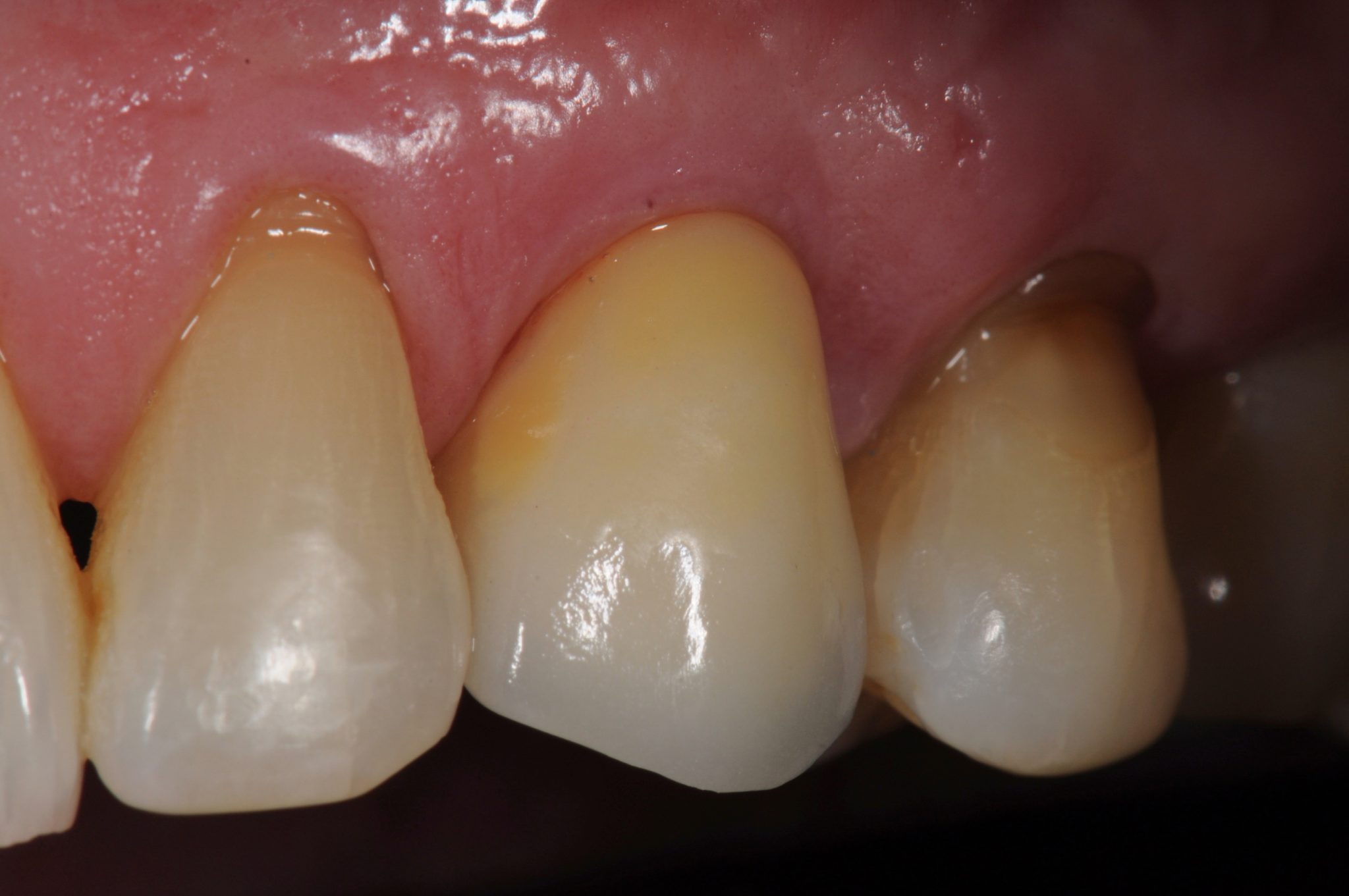 Dental implant-supported transitional prostheses - ITI Blog