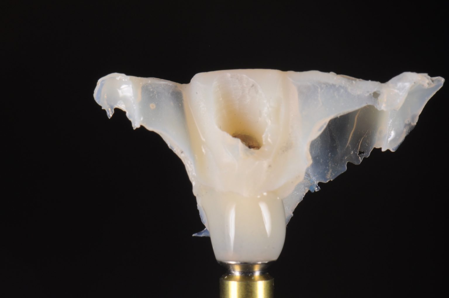 Dental implant-supported transitional prostheses - ITI Blog