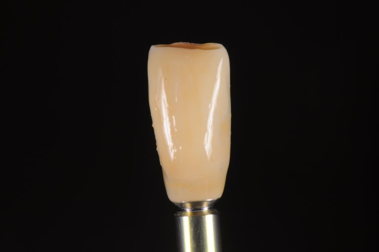 Dental implant-supported transitional prostheses - ITI Blog