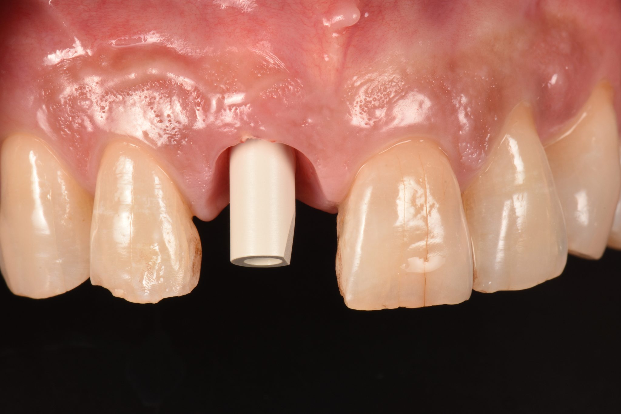 Dental implant-supported transitional prostheses - ITI Blog