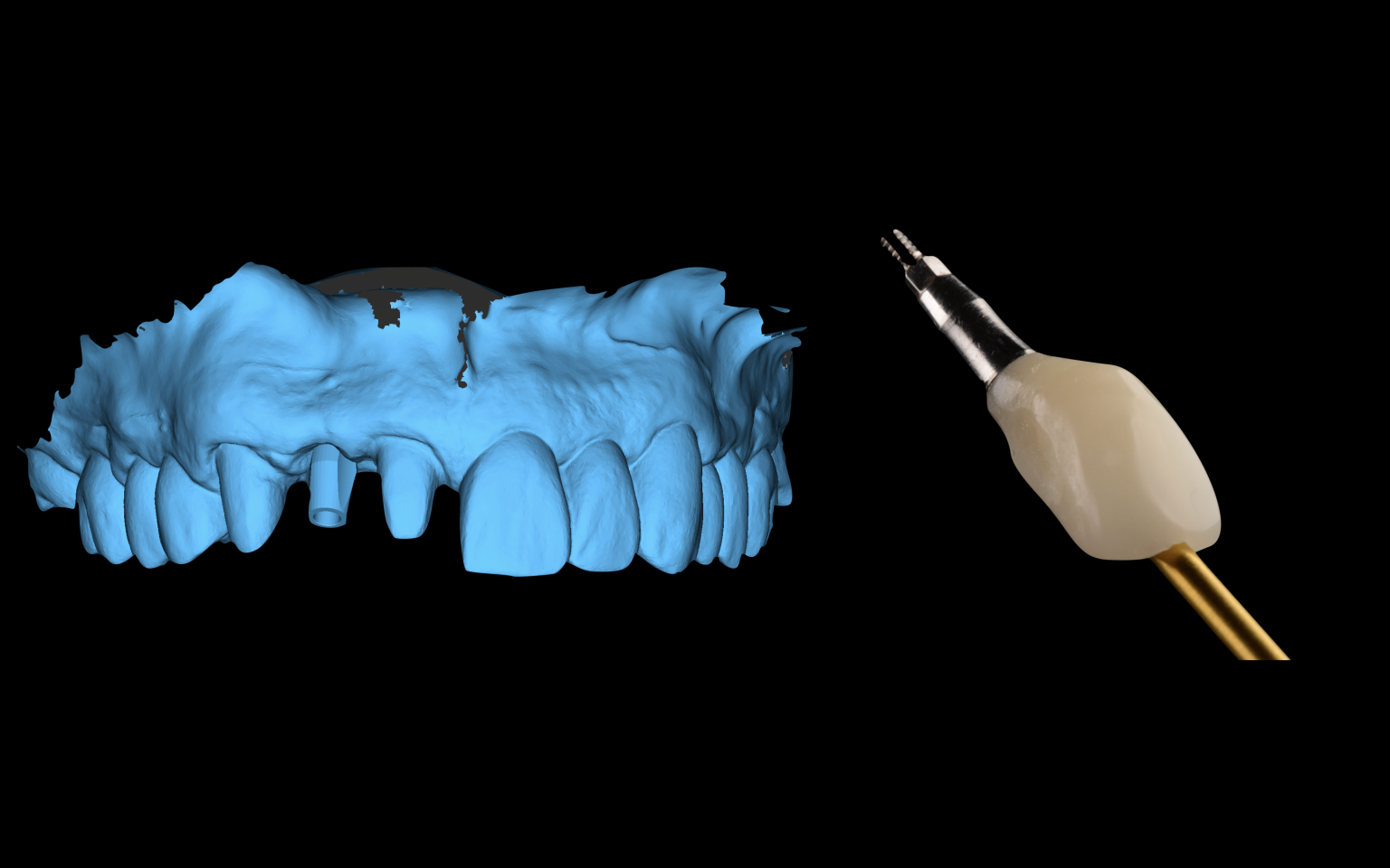 IO scanner as a tool in a surgical practice - ITI Blog