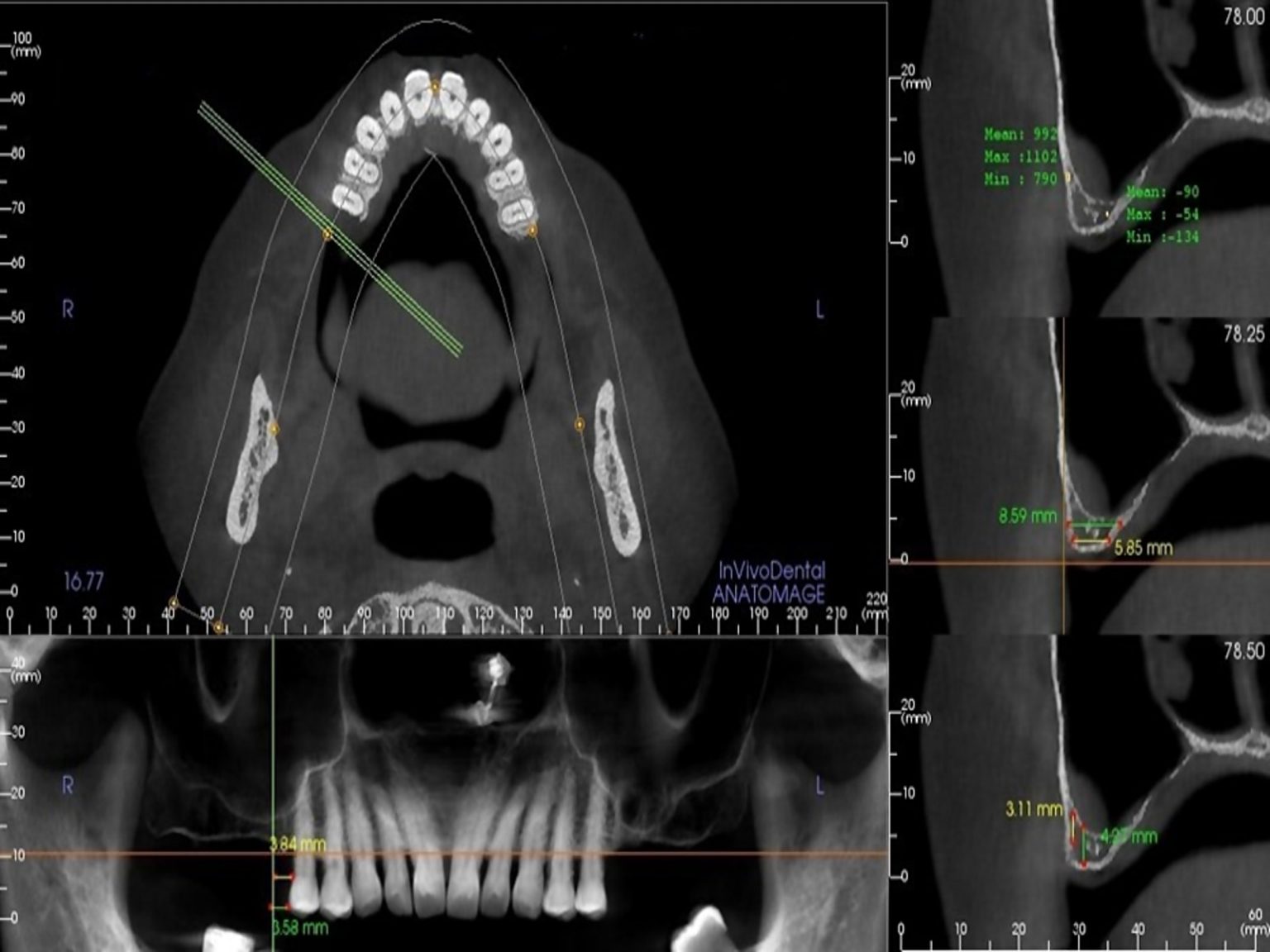 Sinus floor elevation in implant dentistry - ITI Blog