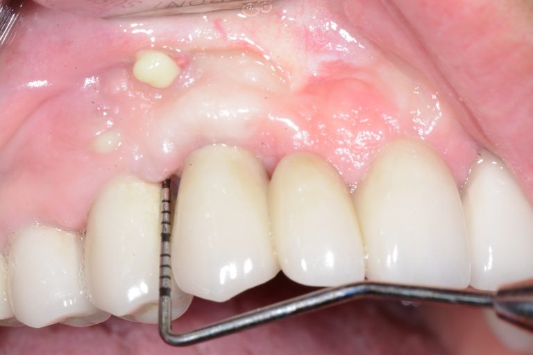 Peri-implantitis: Prevent, Recognize & Treat - ITI Blog