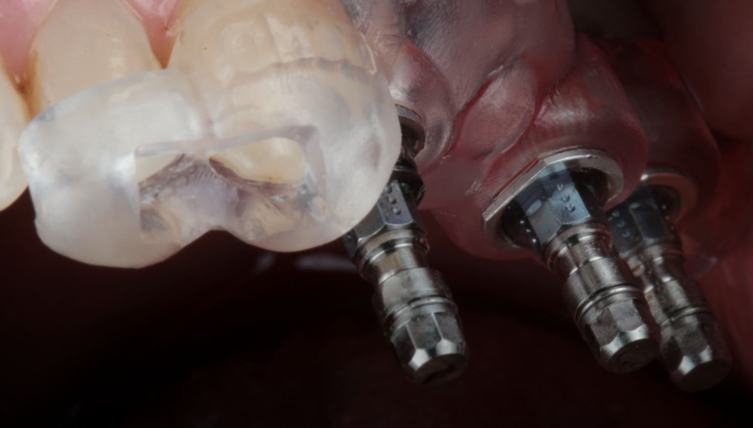 Tips in guided dental implant placement - ITI Blog