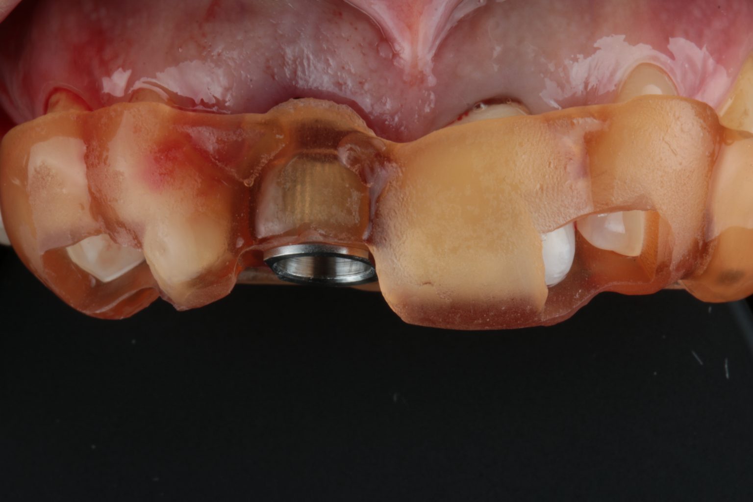 Tips in guided dental implant placement - ITI Blog