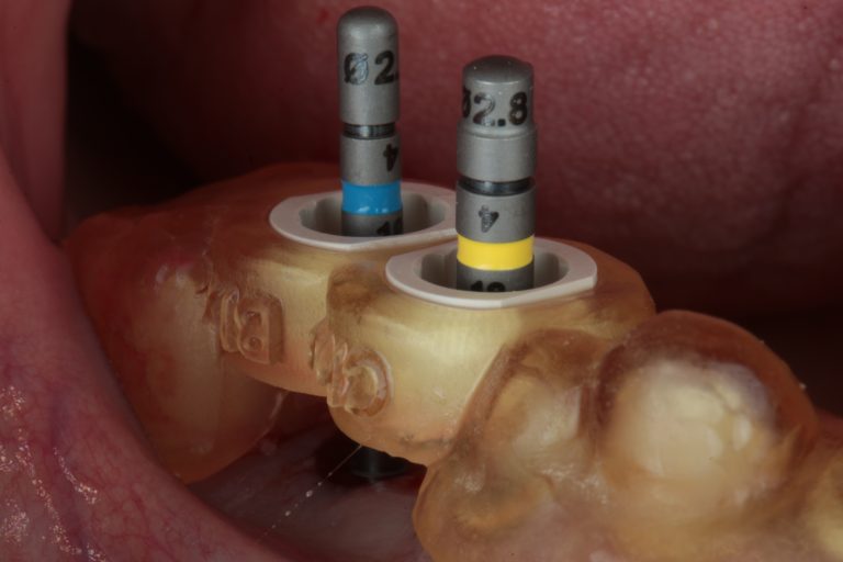 Tips in guided dental implant placement - ITI Blog
