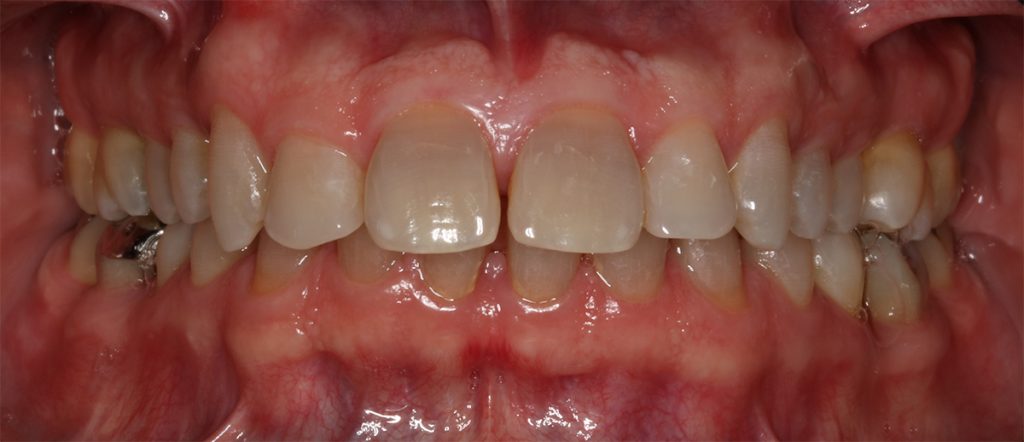 Diagnosing and treating periodontitis prior to implant placement - ITI Blog