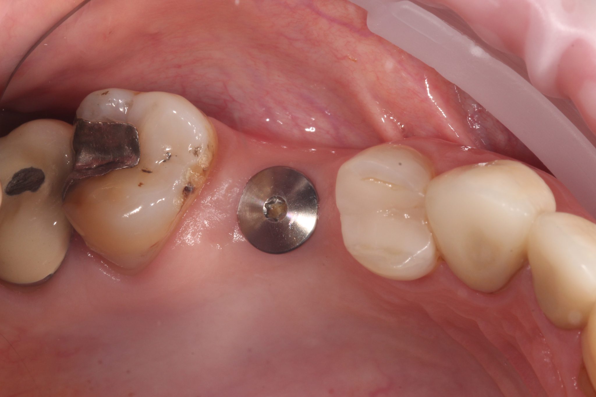 The benefits of tissue level implants restoratively - ITI Blog