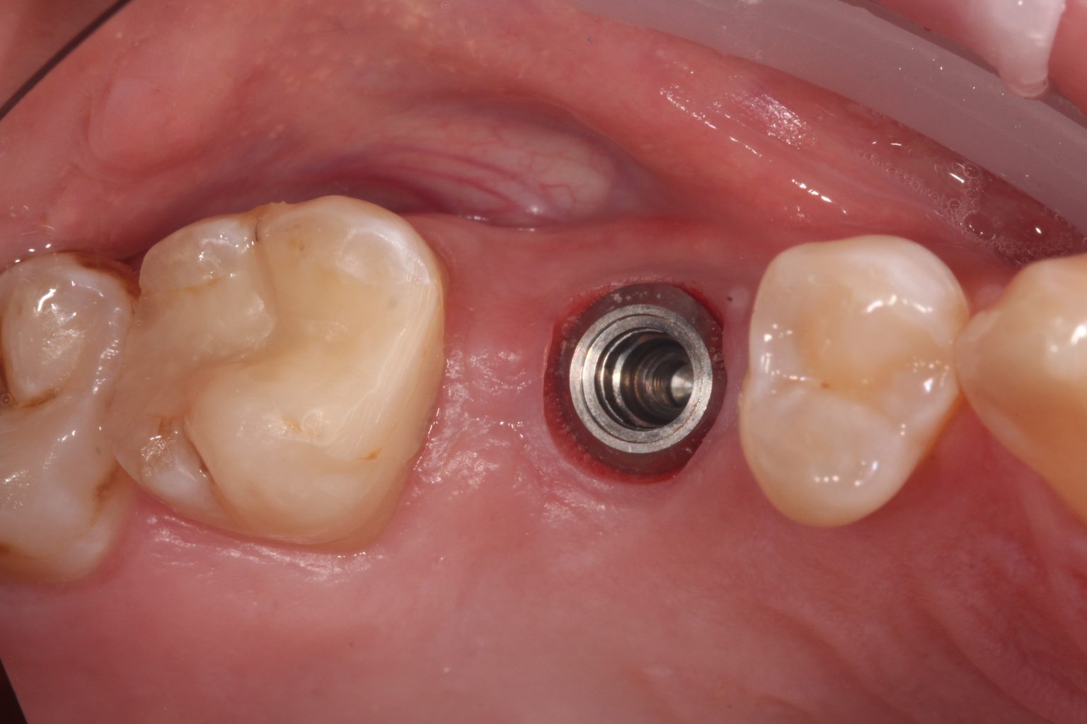 The benefits of tissue level implants restoratively - ITI Blog