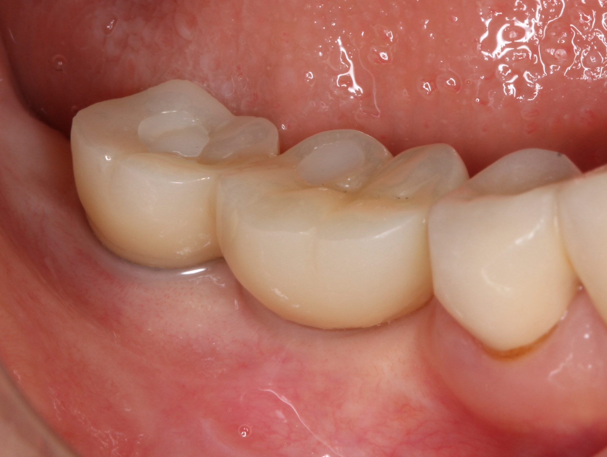 Four reasons to choose tissue-level implants for posterior sites - ITI Blog