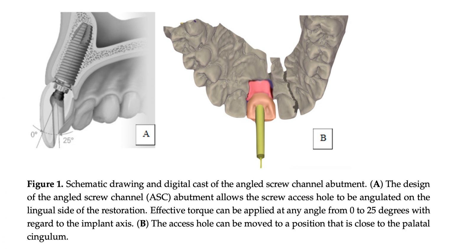Angulated screw channel solutions - ITI Blog
