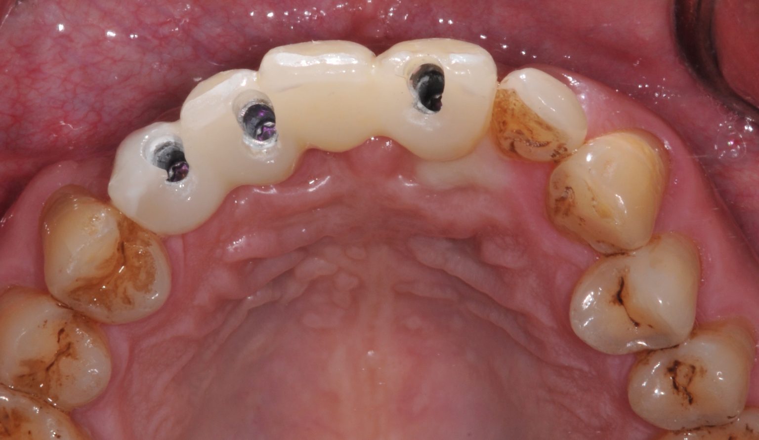 Angulated screw channel solutions - ITI Blog