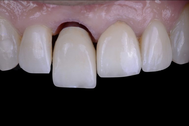 Guidelines for ridge preservation: when and how - ITI Blog