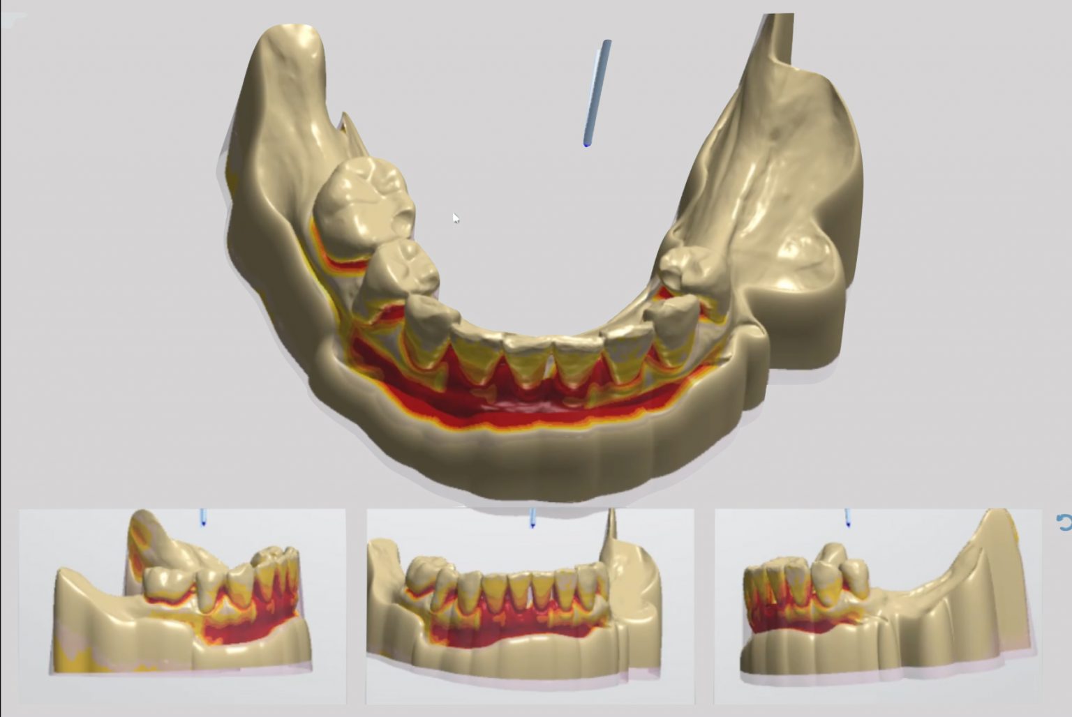 Digital Workflow for Removable Prosthesis