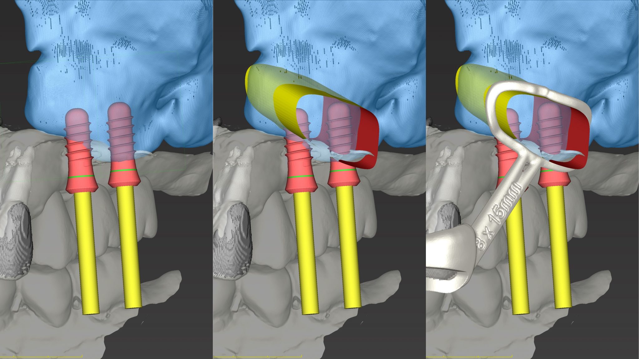 A Safe, Predictable and Efficient Way to Create a Lateral Window during ...