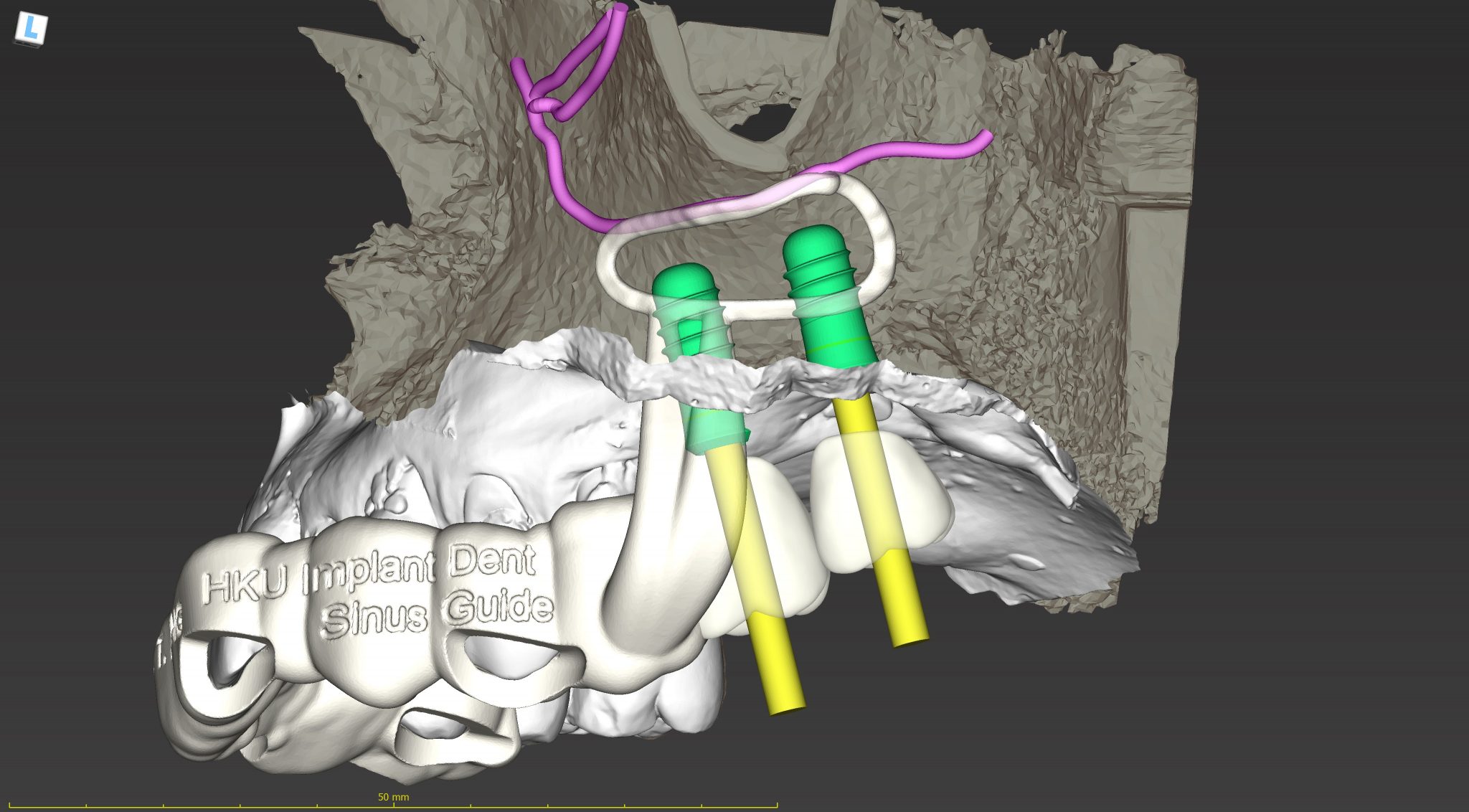 A Safe, Predictable and Efficient Way to Create a Lateral Window during ...