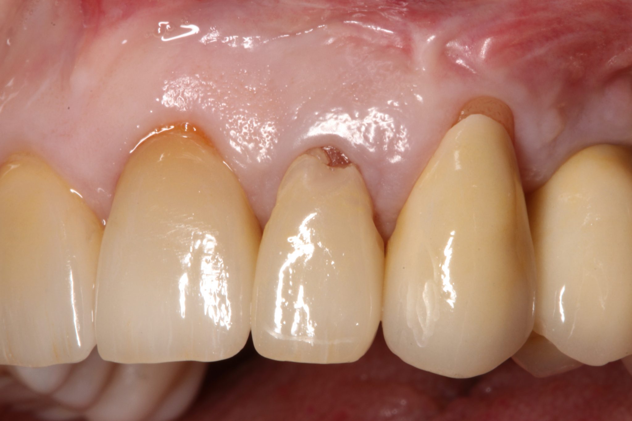Why we should assess gingival phenotypes in daily practice – gingival ...
