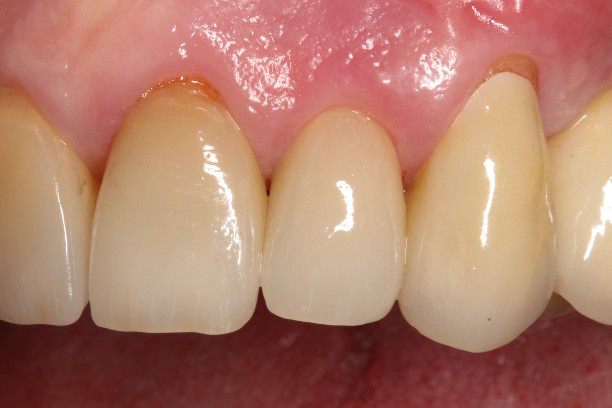 Why we should assess gingival phenotypes in daily practice – gingival ...