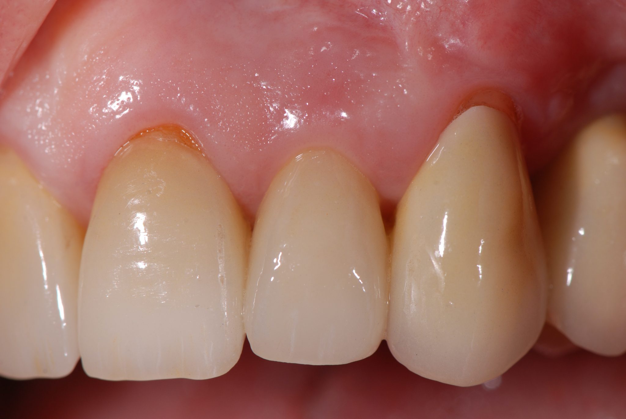 Why we should assess gingival phenotypes in daily practice – gingival ...