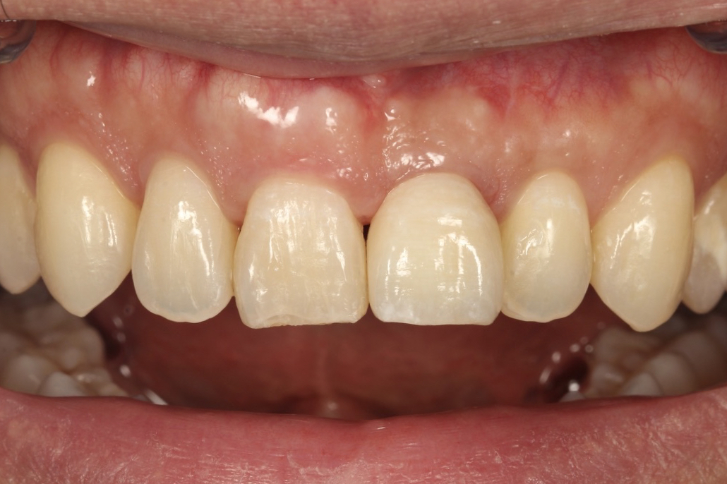 Interproximal papilla for single-tooth implant restorations – risk factors