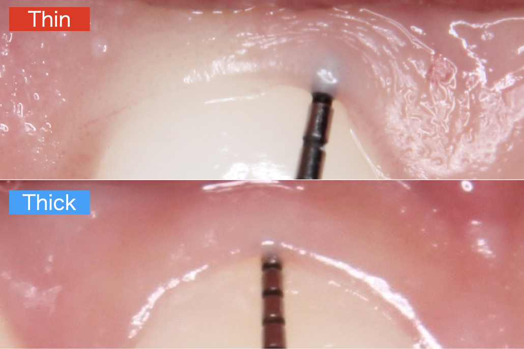 Interproximal papilla for single-tooth implant restorations – risk factors