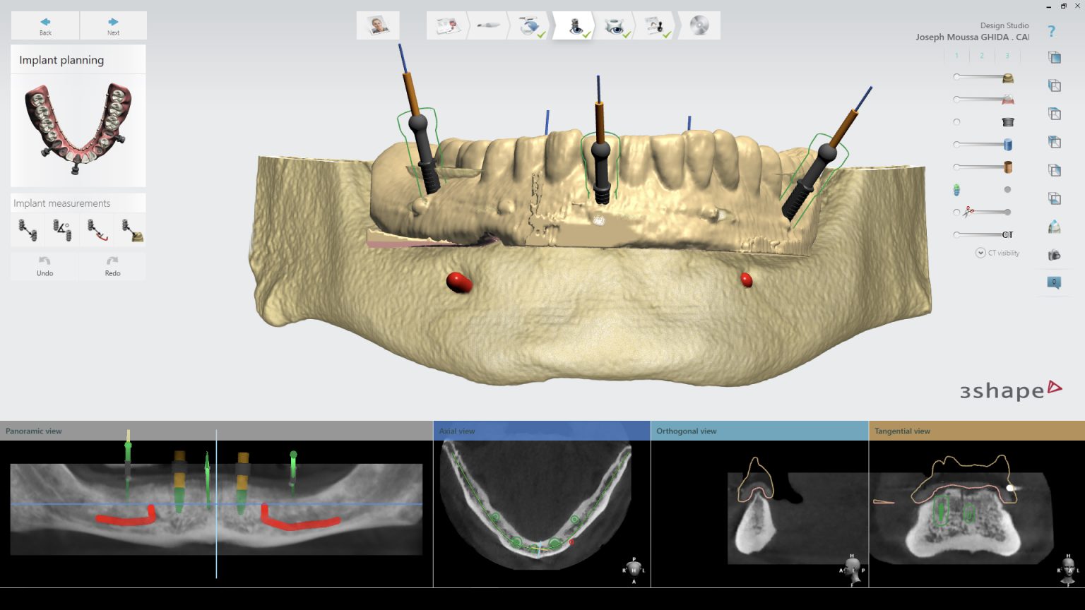 Mandibular locator implant-retained overdentures - ITI Blog