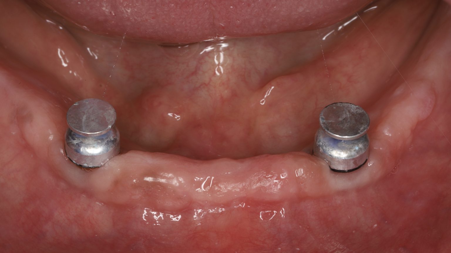 Mandibular locator implant-retained overdentures - ITI Blog