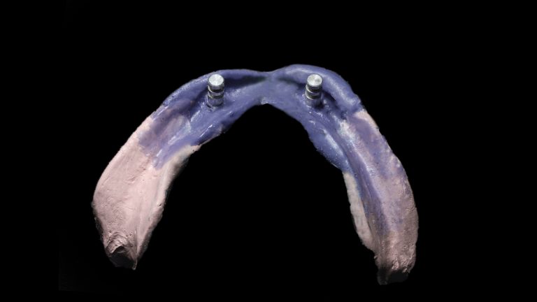 Mandibular locator implant-retained overdentures - ITI Blog