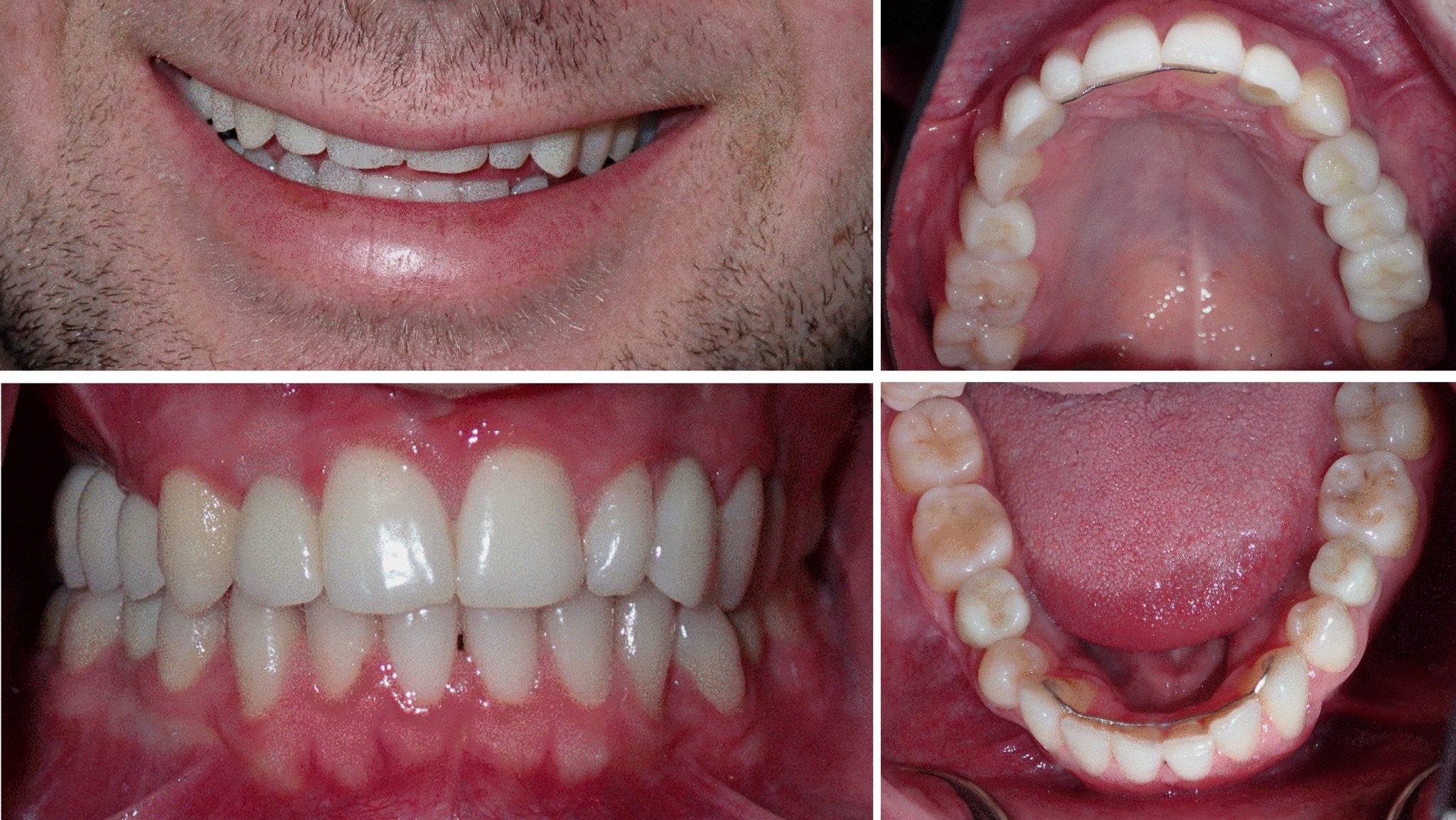 Toronto dental treatment protocol for young individuals with oligodontia