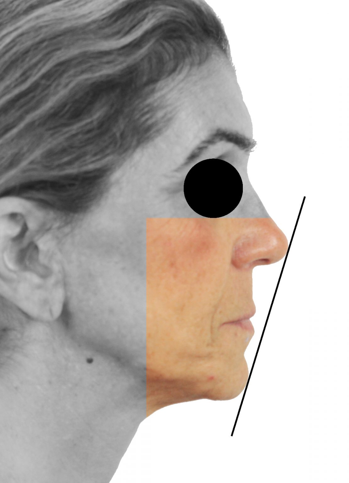 The esthetic parameters in complete full arch rehabilitation - ITI Blog