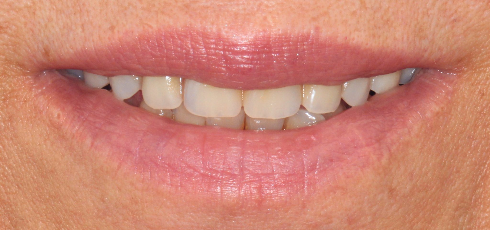 The esthetic parameters in complete full arch rehabilitation - ITI Blog