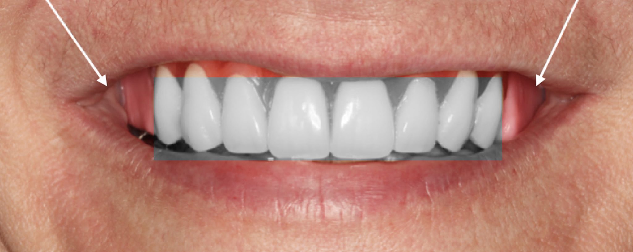 The esthetic parameters in complete full arch rehabilitation - ITI Blog