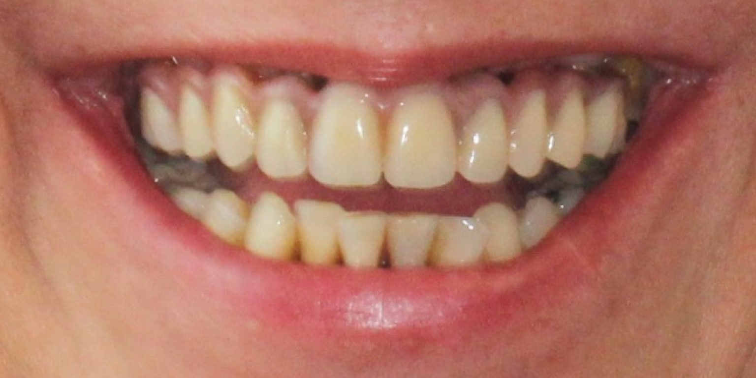 The esthetic parameters in complete full arch rehabilitation - ITI Blog