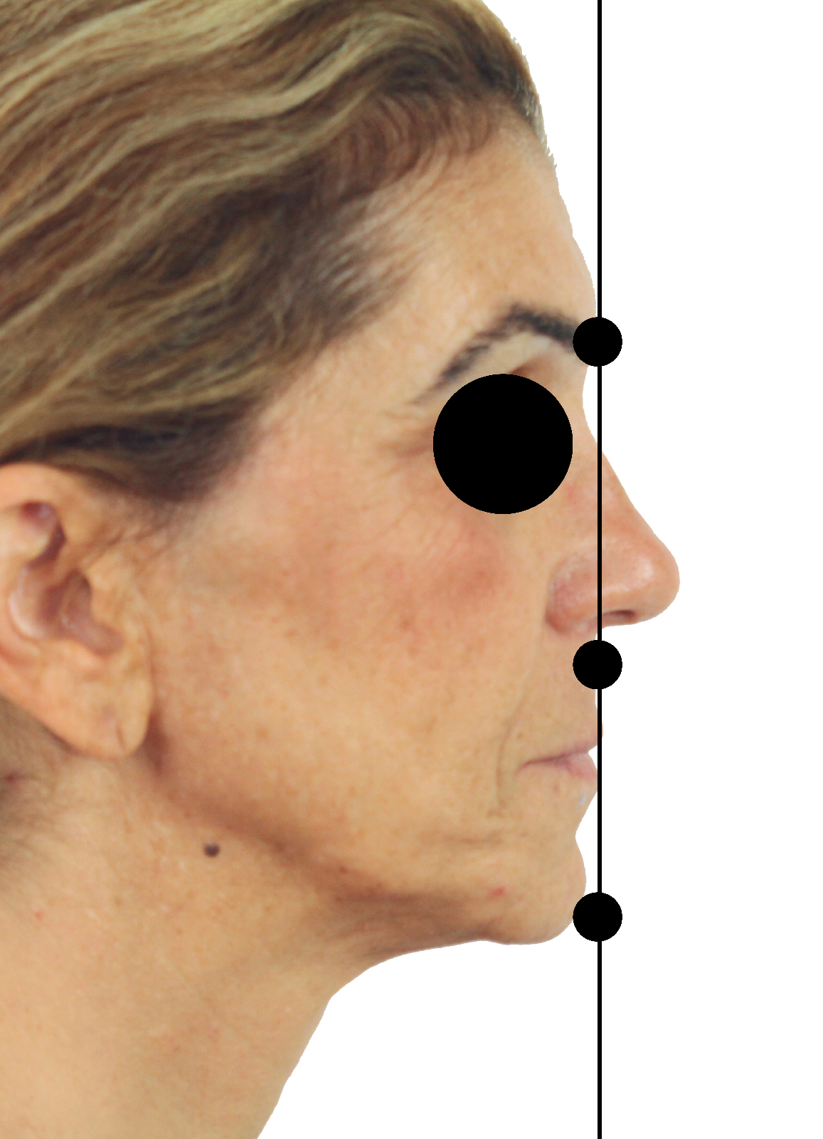 The esthetic parameters in complete full arch rehabilitation - ITI Blog