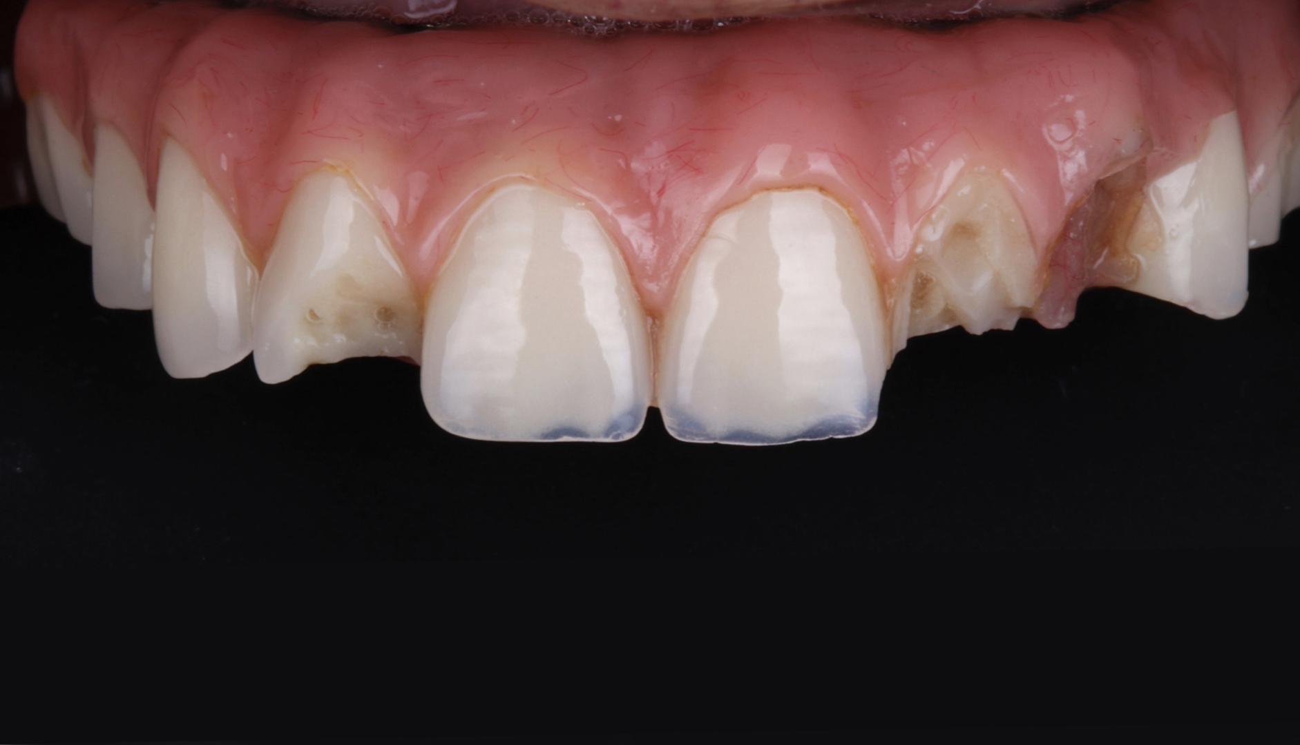 10 considerations on the use of monolithic zirconia for one piece ...