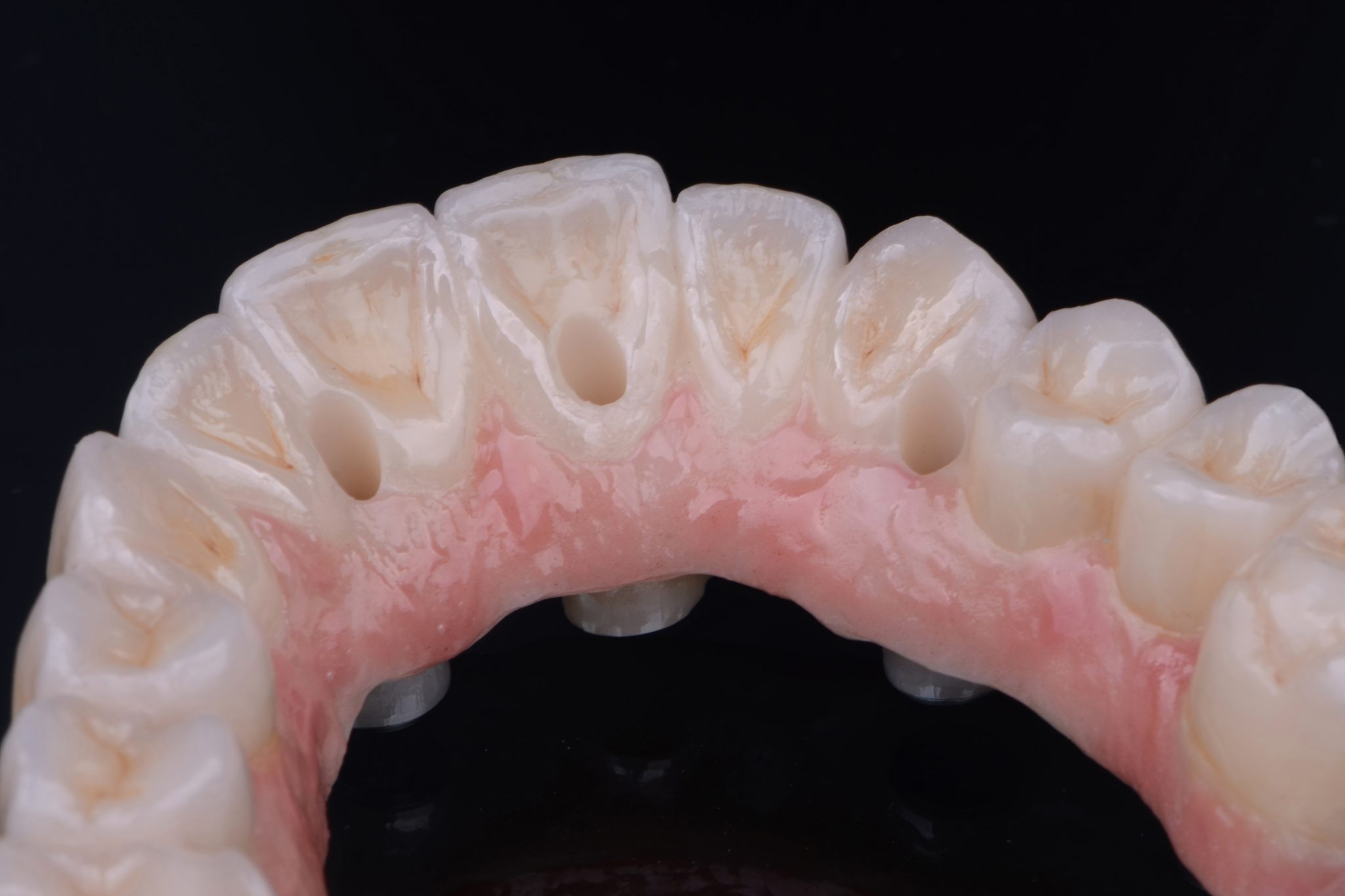 10 considerations on the use of monolithic zirconia for one piece ...
