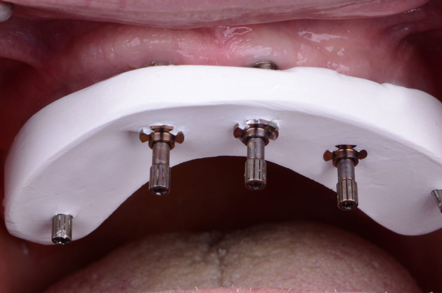 10 considerations on the use of monolithic zirconia for one piece ...
