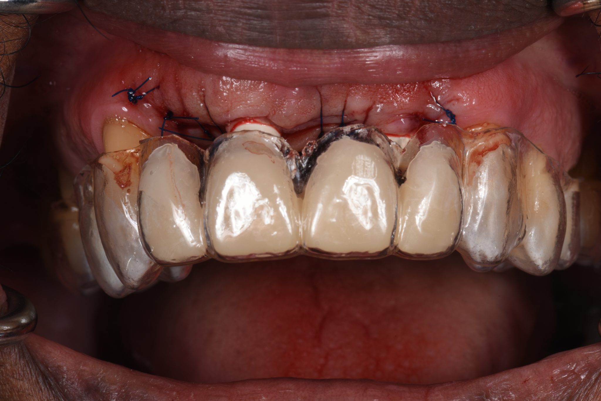 Multidisciplinary care: Utilization of the implant portfolio - ITI Blog