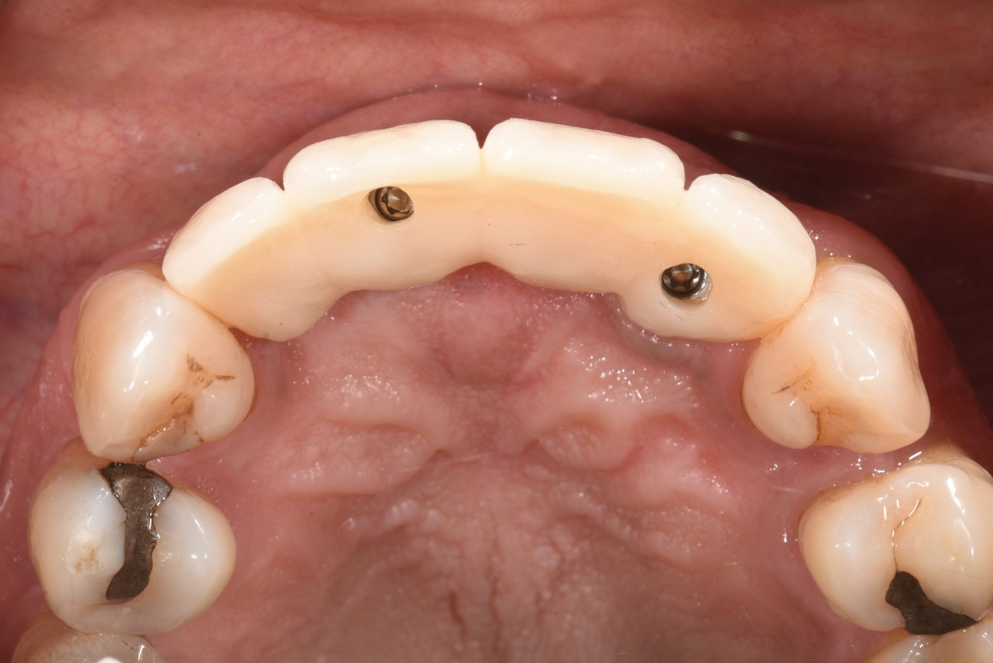 Multidisciplinary care: Utilization of the implant portfolio - ITI Blog